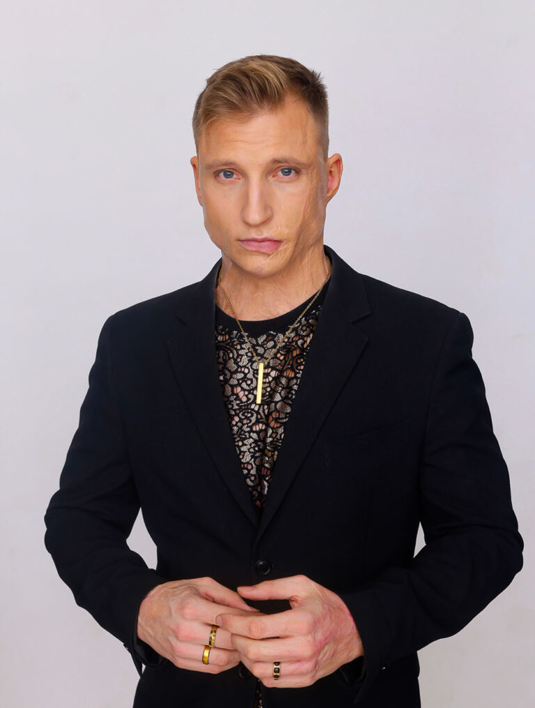 Axel Schylström visar upp sina ärr i Melodifestivalen